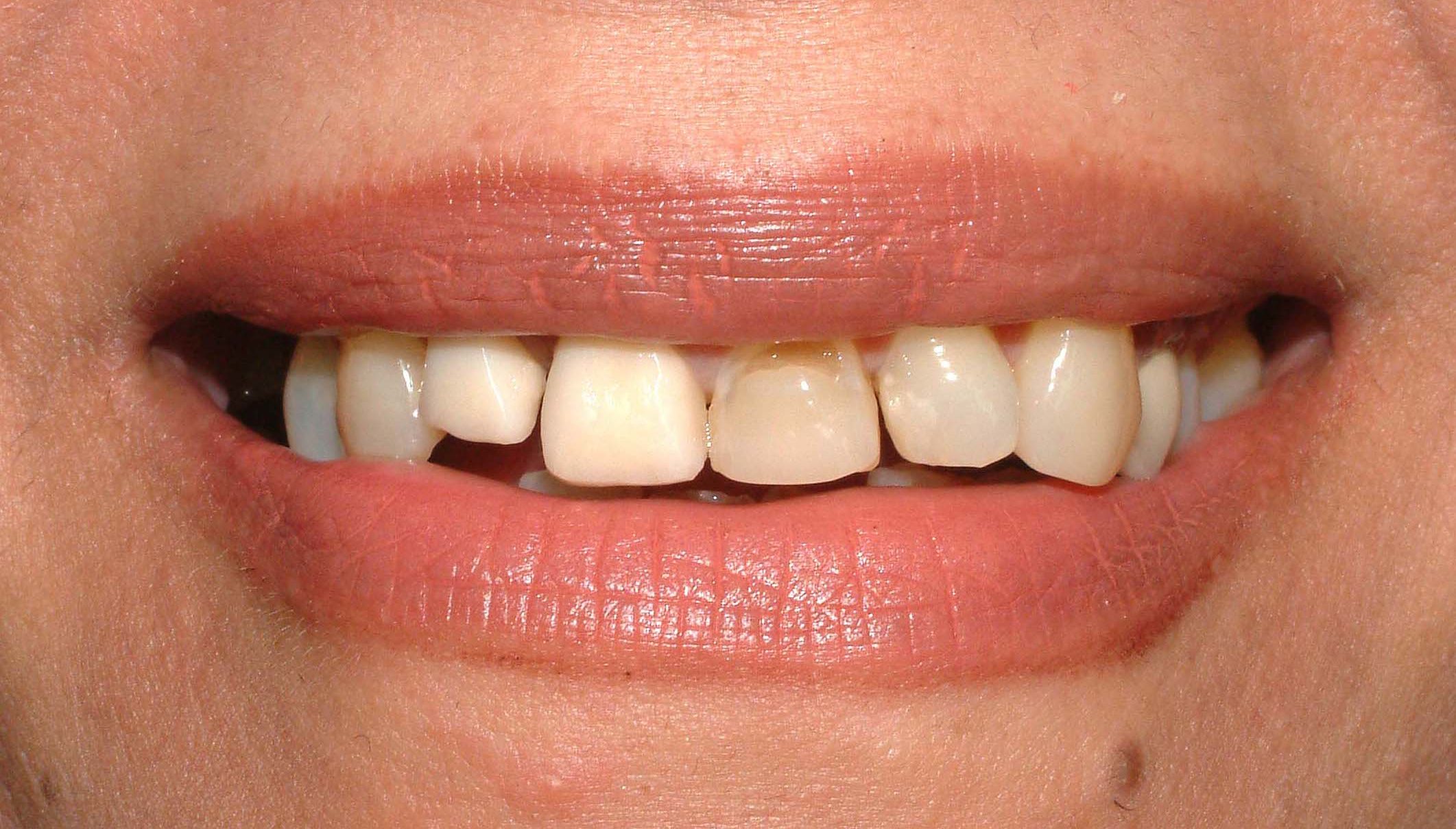 Patient Gallery - Dollarton Dental